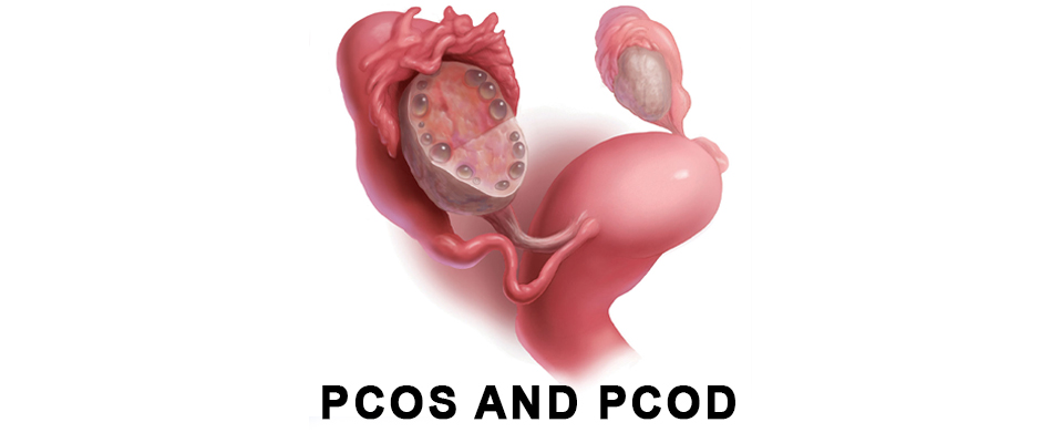 PCOD vs PCOS: Differences, Symptoms & Treatment in India